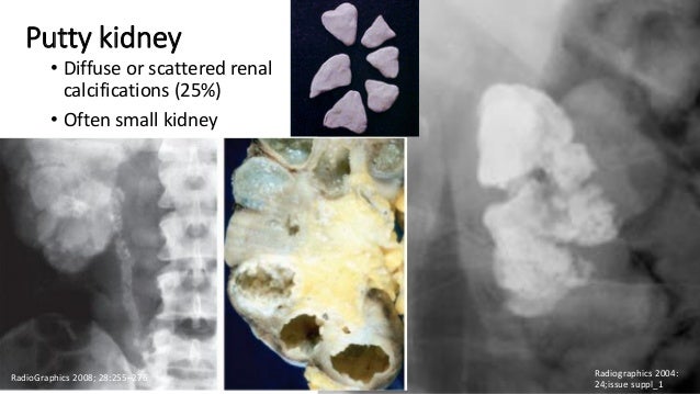 Inflammatory diseases of the kidney Part 2