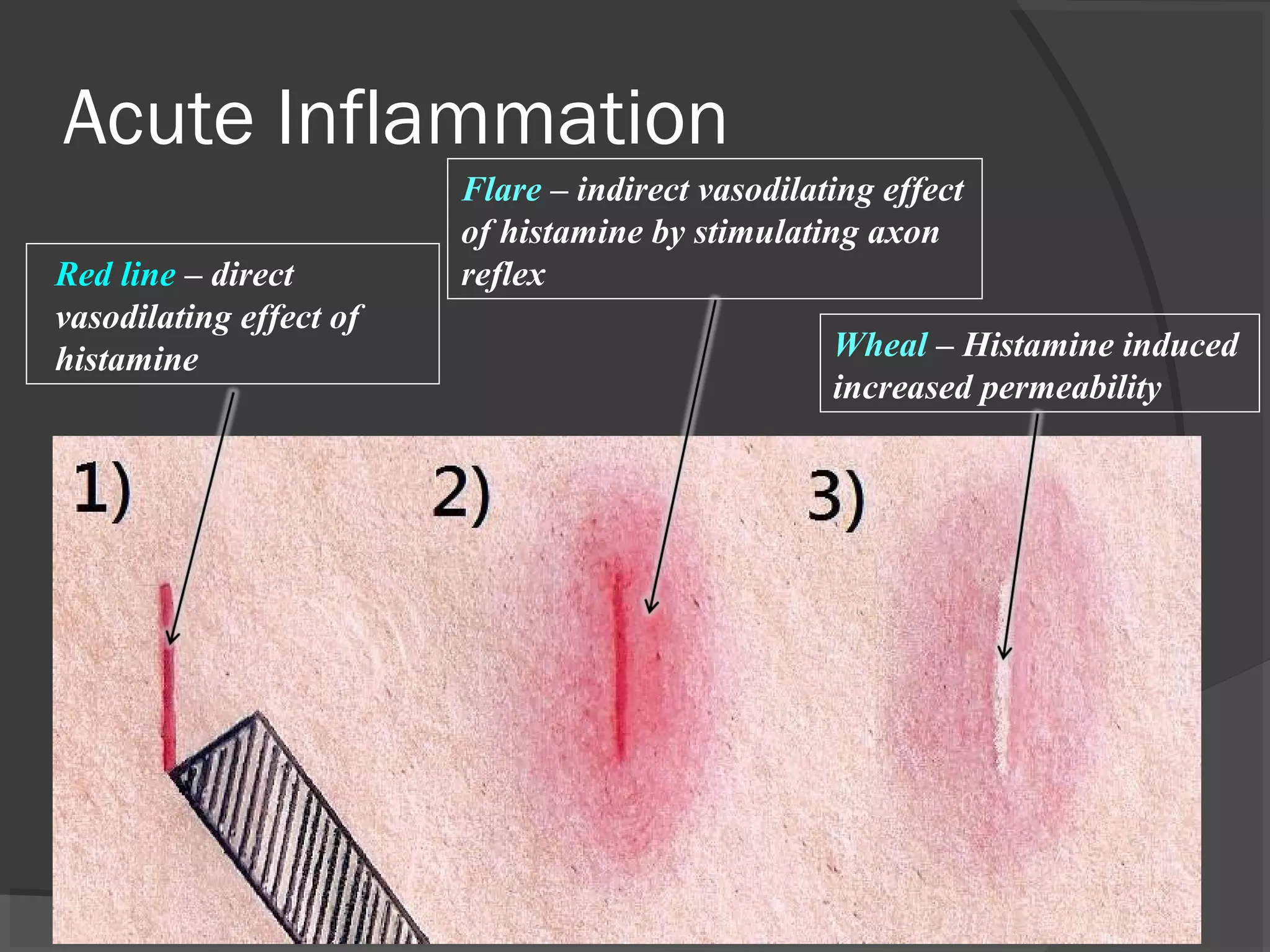 Inflammation | PPT