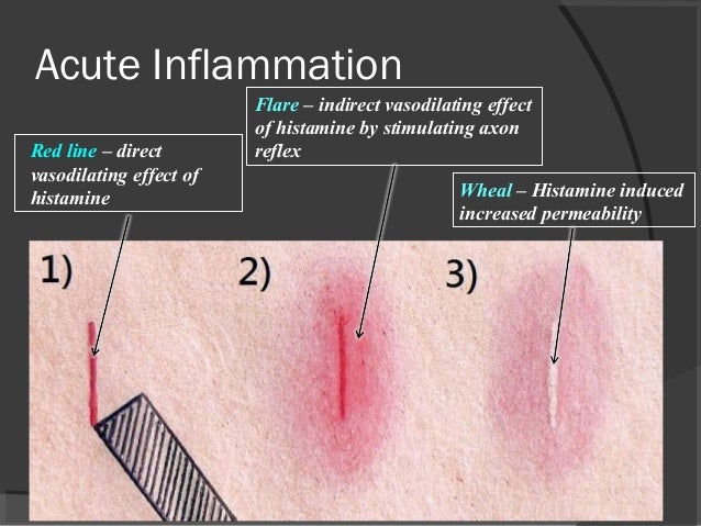 Inflammation