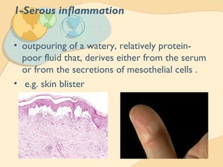 Inflammation | PPT