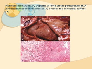 Inflammation | PPT