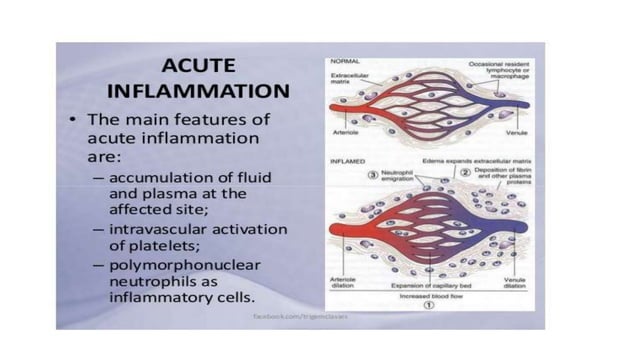 Pathophysiology of Inflammation | PPT