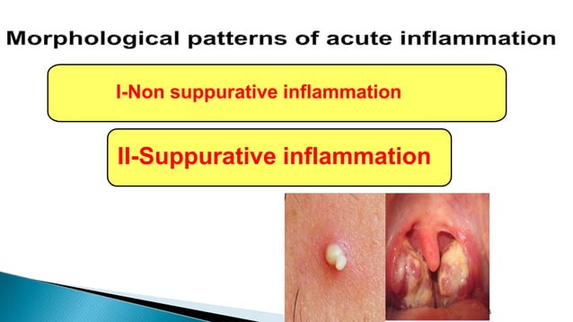 inflammation.pptx