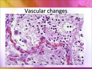 Inflammation ospe rapid review | PPT