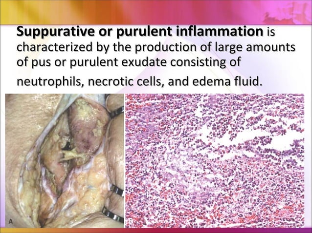 Inflammation ospe rapid review | PPT