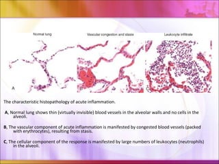 Inflammation ospe rapid review | PPT