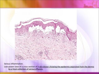Inflammation ospe rapid review | PPT