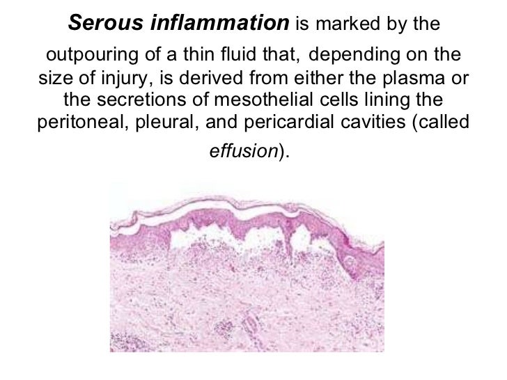 Inflammation Part 2