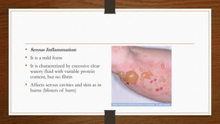 Inflammation 3 | PPTX