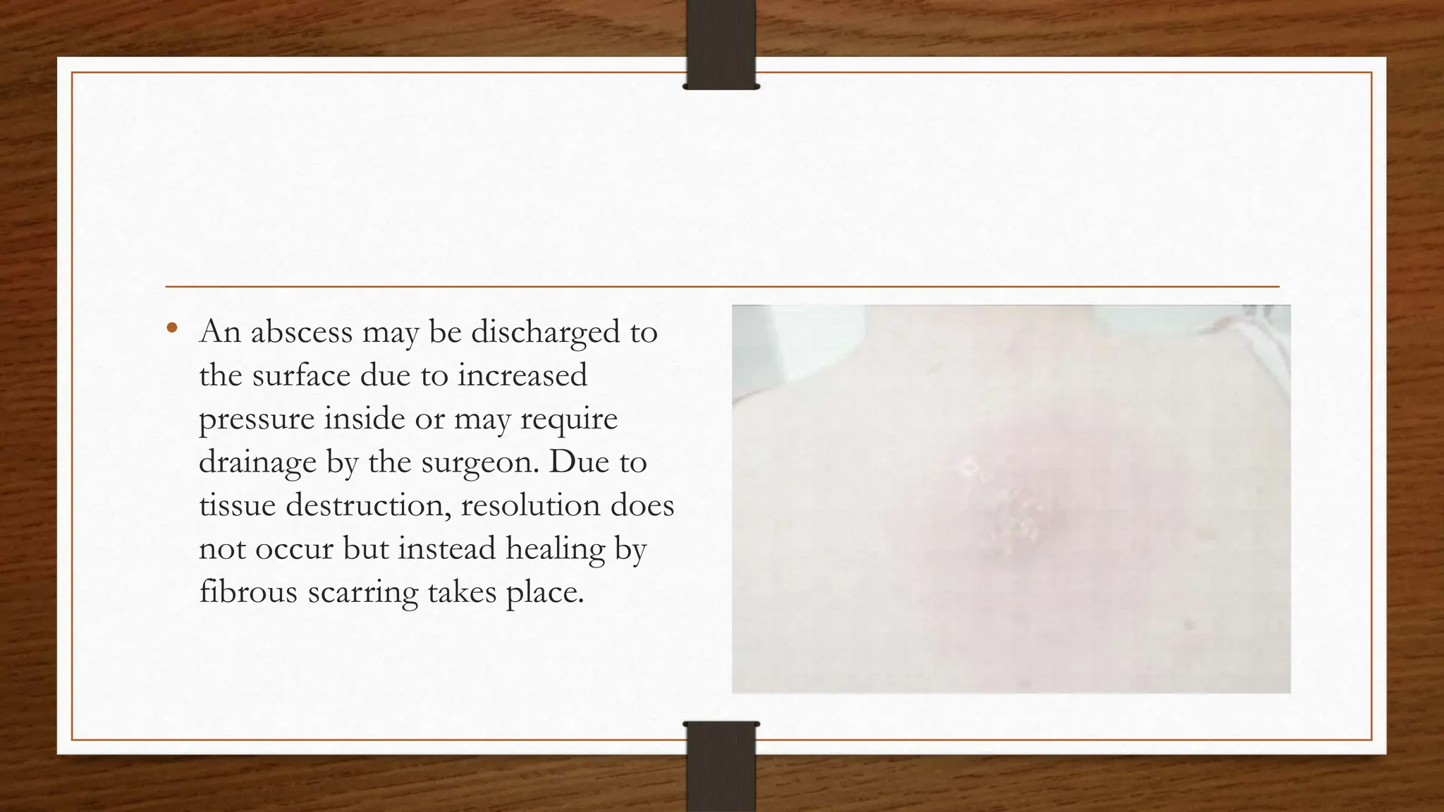 Inflammation 3 - inflammation pathology lecture series | PPT