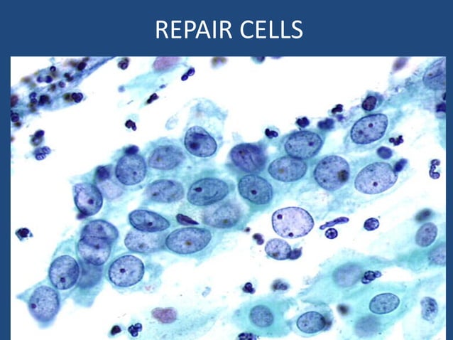 INFLAMMATION AND OTHER BENIGN REACTIVE CHANGES.ppt.pdf | Blood ...