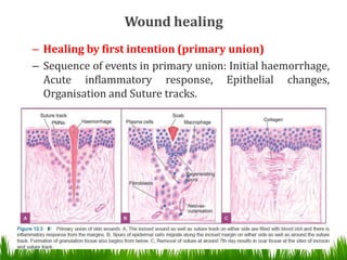 Inflammation and repair | PPTX