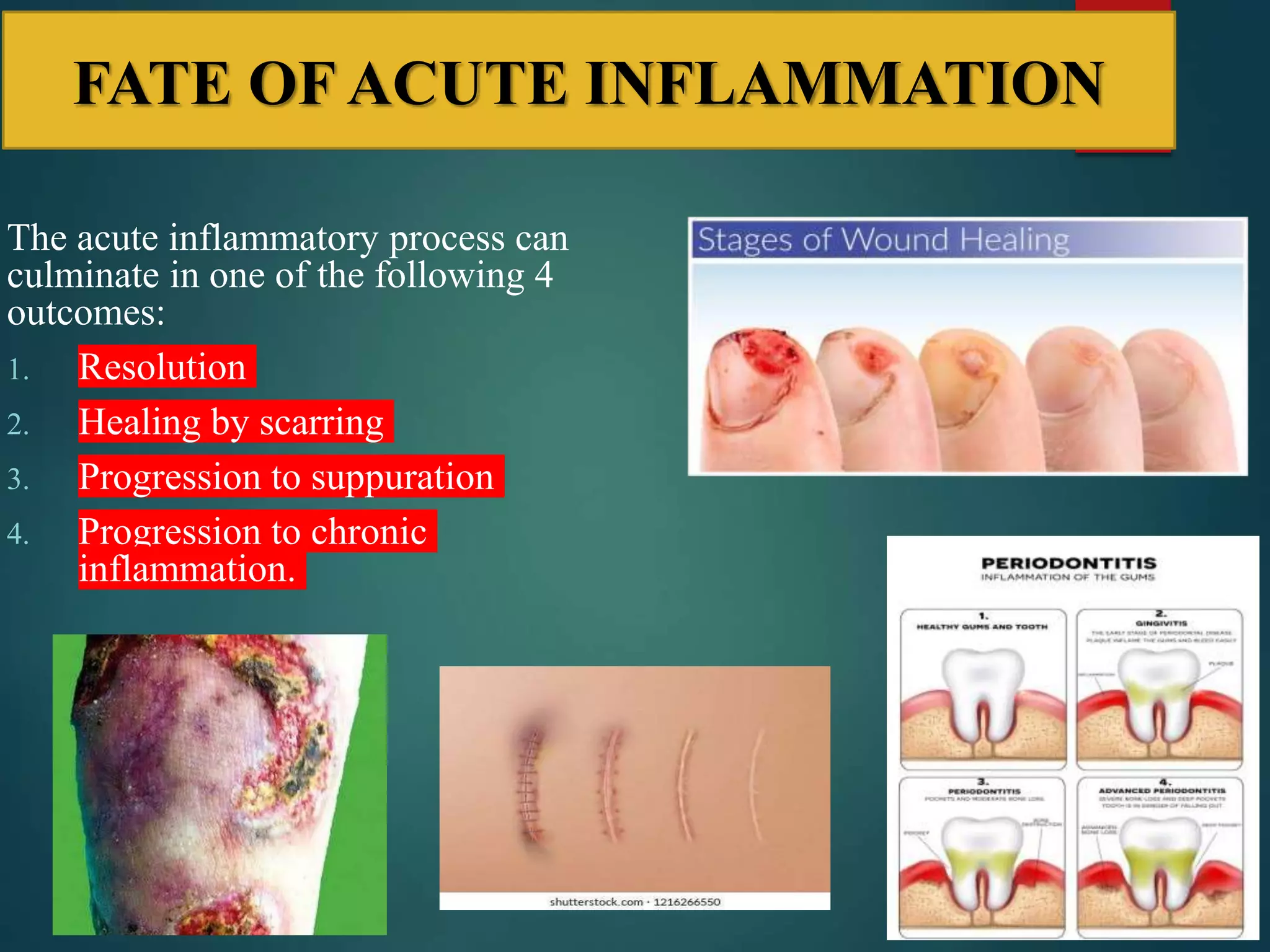 Inflammation | PPT