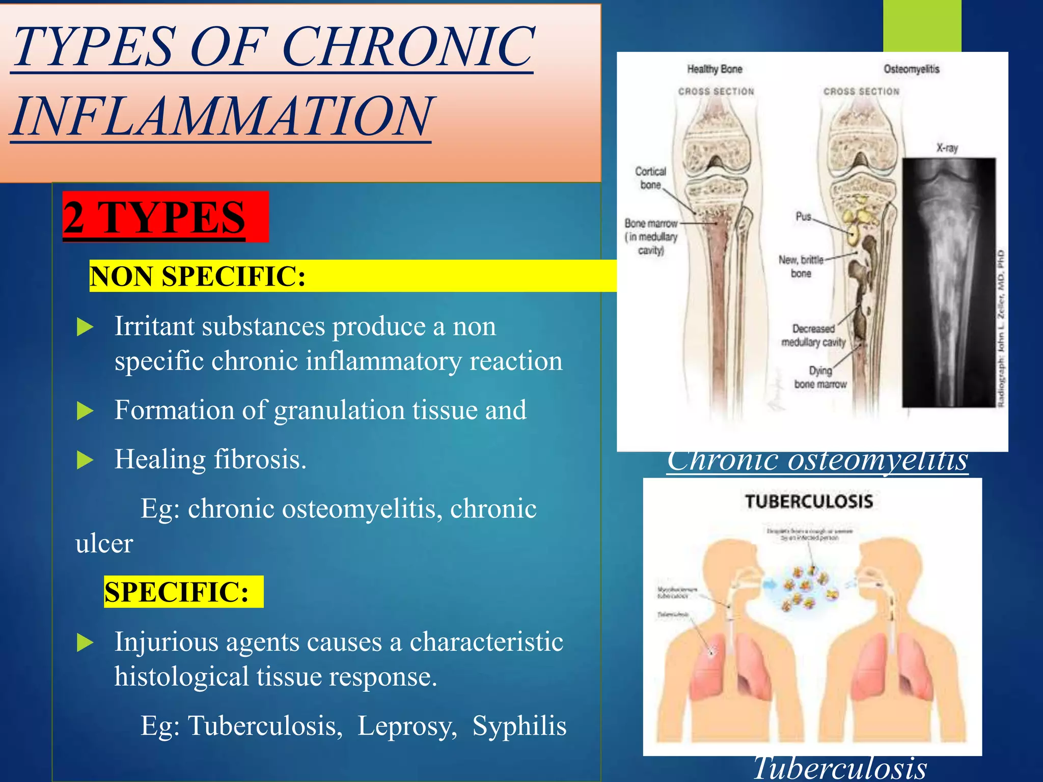 Inflammation | PPT