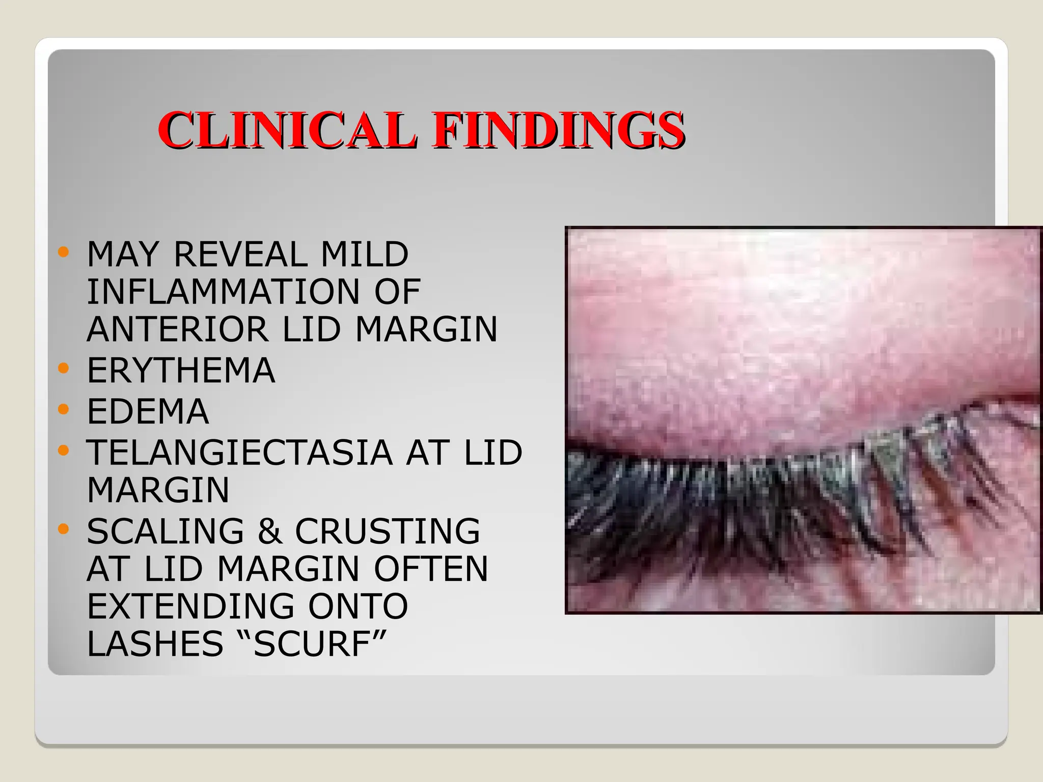 INFLAMMATION & INFECTIONS OF EYELIDS.ppt