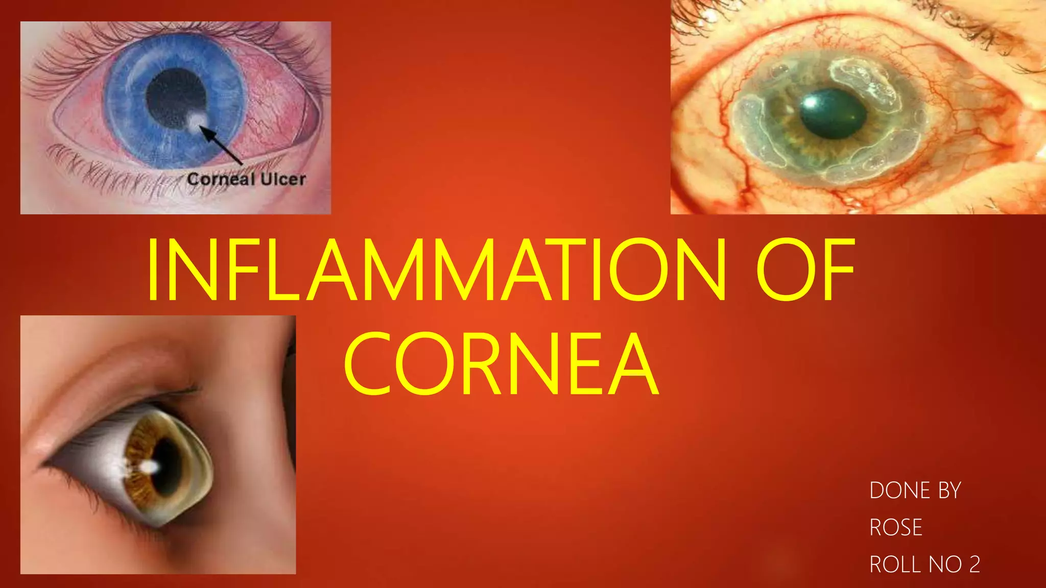 Inflammation of cornea | PPTX