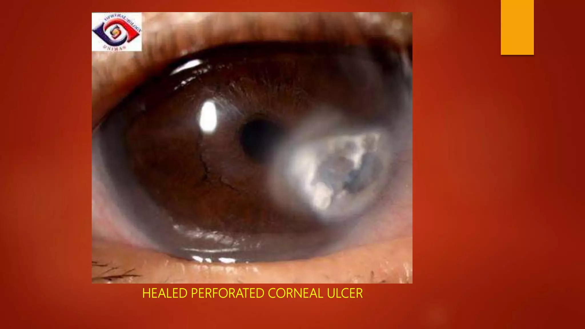 Inflammation of cornea | PPTX