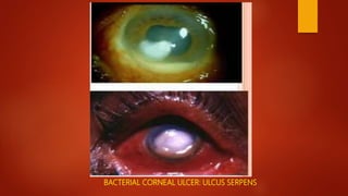 Inflammation of cornea | PPTX