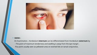 INFLAMMATION OF EYELID GLANDS ETIOLOGY CLINICAL FINDINGS AND MANAGEMENT ...