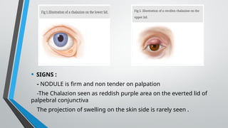 INFLAMMATION OF EYELID GLANDS ETIOLOGY CLINICAL FINDINGS AND MANAGEMENT ...