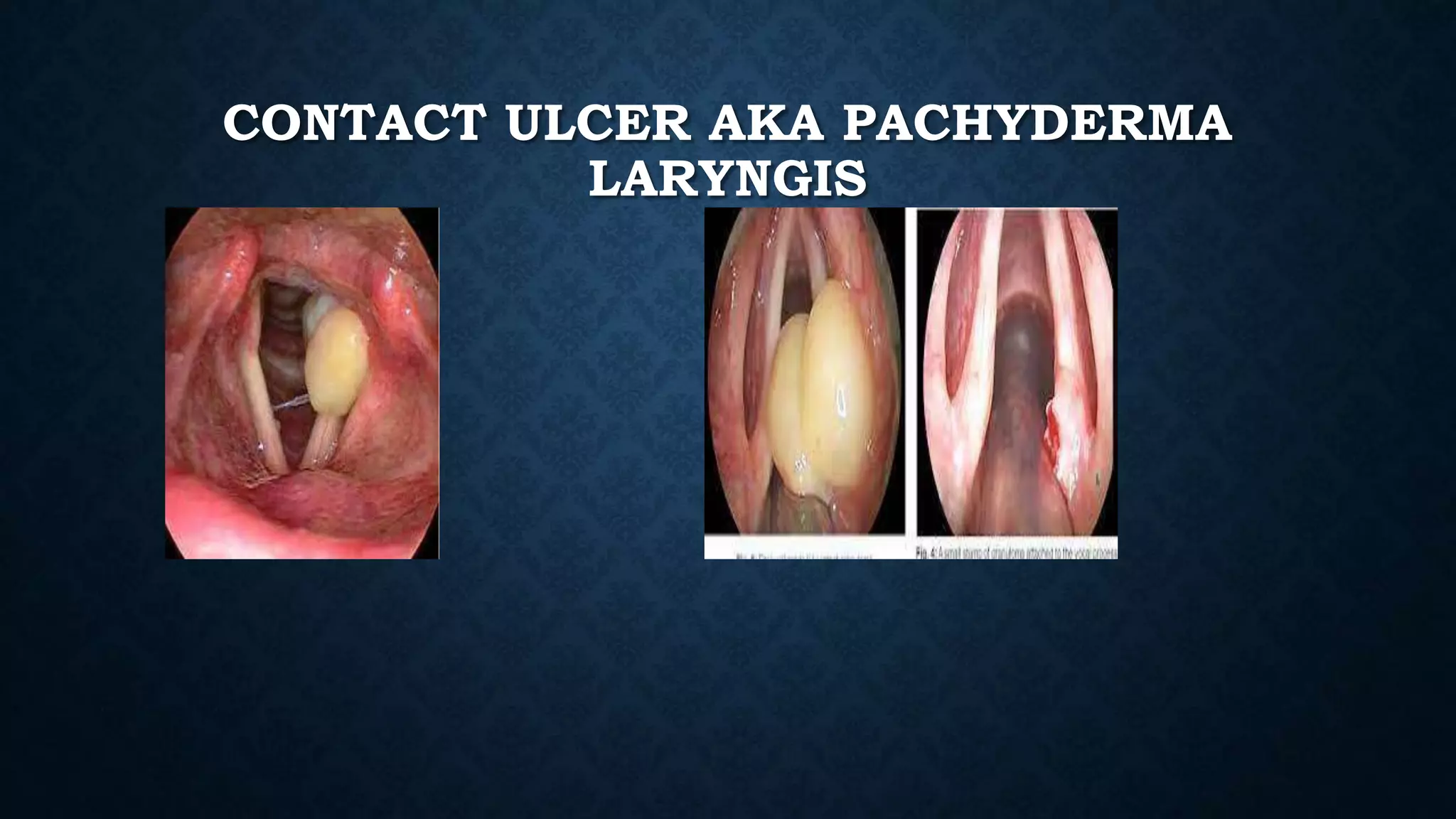 Inflammations of larynx.pptx
