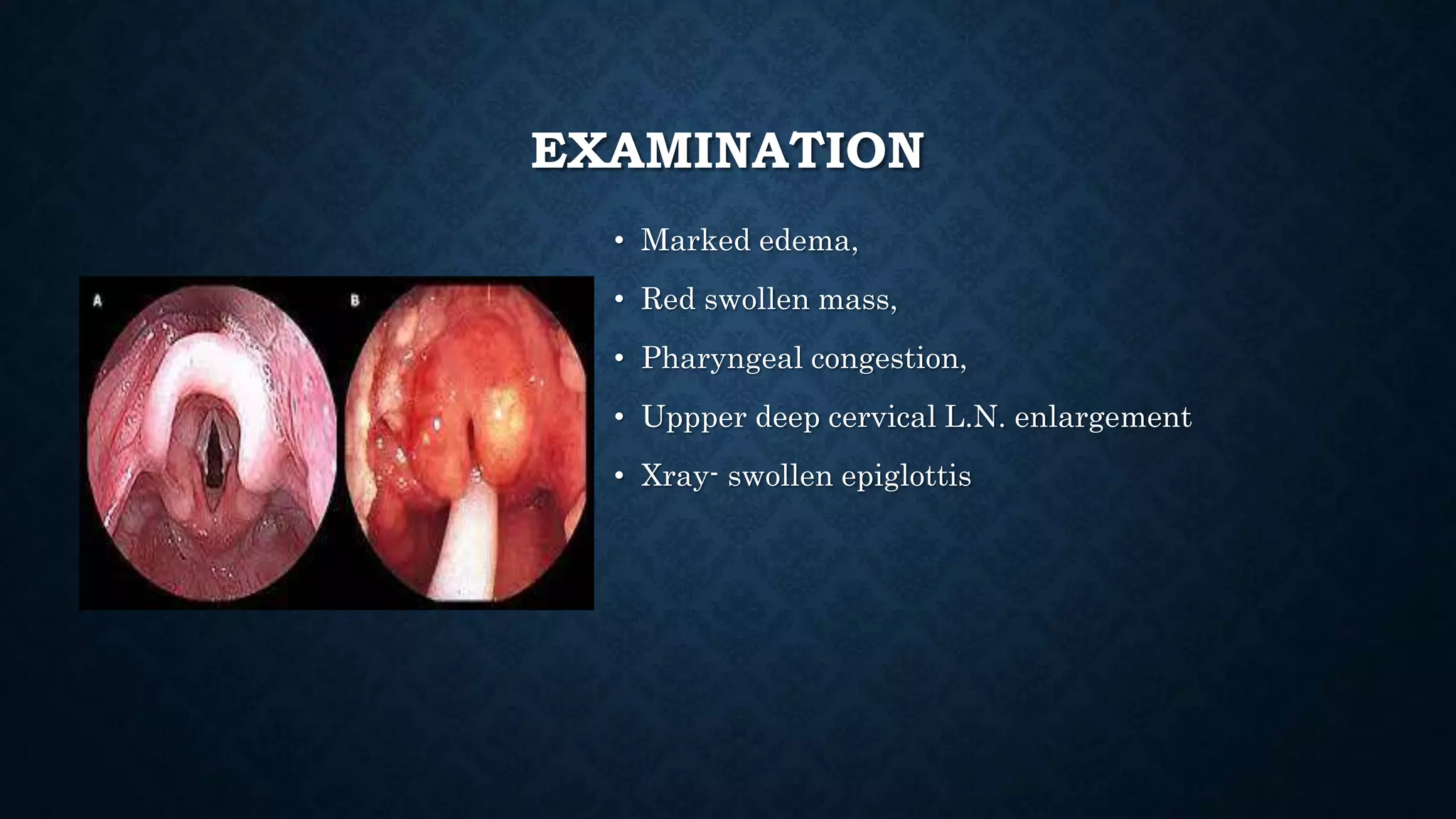 Inflammations of larynx.pptx