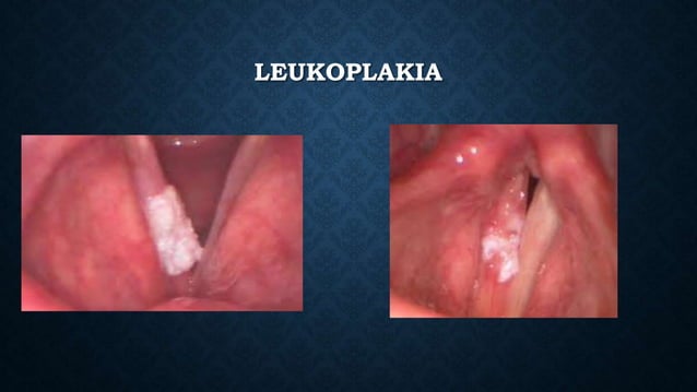 Inflammations of larynx.pptx