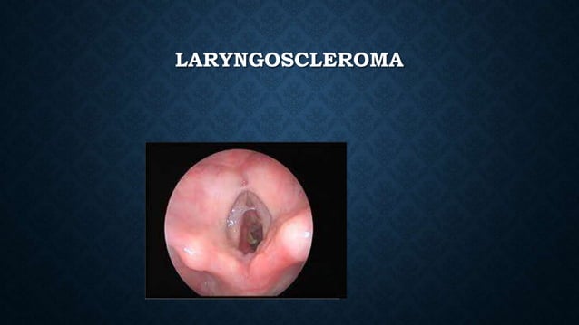 Inflammations of larynx.pptx