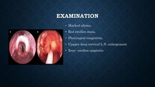 Inflammations of larynx.pptx