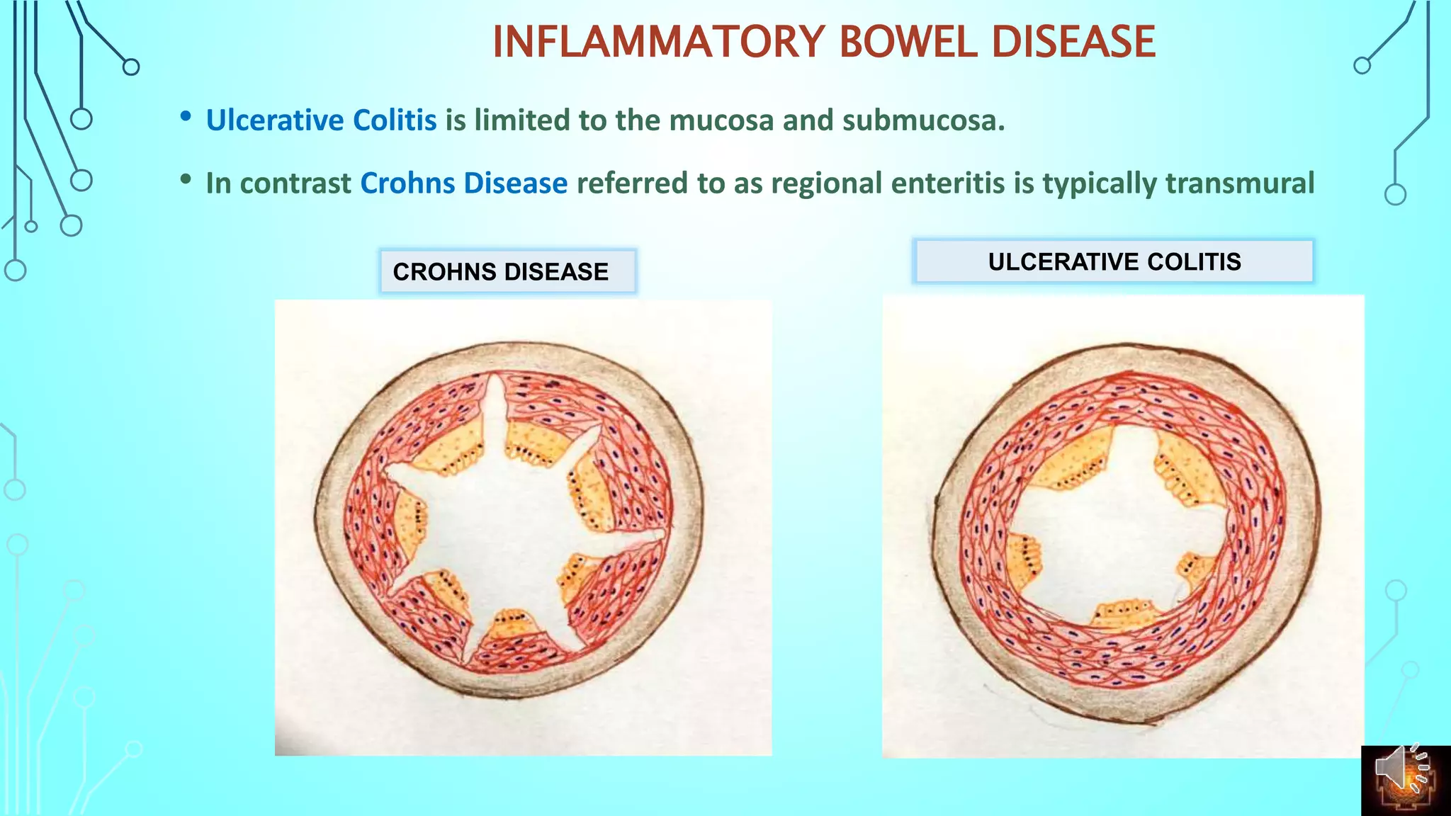 Inflammatory-bowel-disease-pathogenesis.ppt