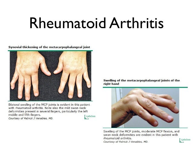 Inflammatory Arthritis