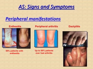 inflammatoryarthritis-170820154705 (1).pdf | Bone and Joint Conditions ...