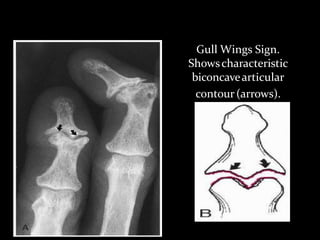 Inflammatory arthritis | PPT