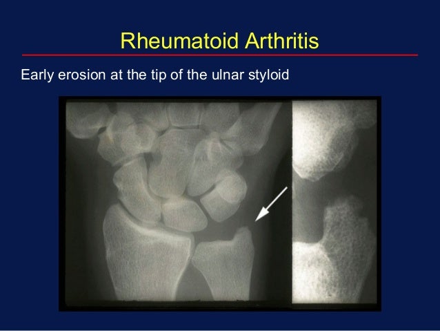 Inflammatory arthritis an overview