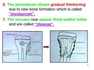 Inflammatory bone diseases & bone fracture_Dr.Manal Ismail Abd-Elghany ...