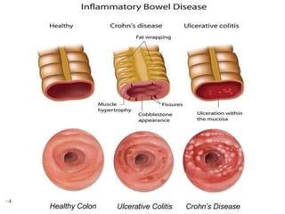inflammatory bowel diseas.pptx