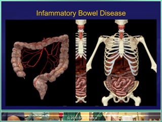 Inflammatory Bowel Disease | PPTX