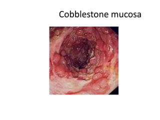 Inflammatory bowel disease | PPT