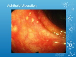 Inflammatory bowel disease | PPT