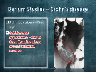 Inflammatory bowel disease | PPTX