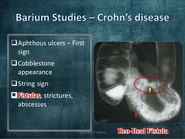Inflammatory bowel disease