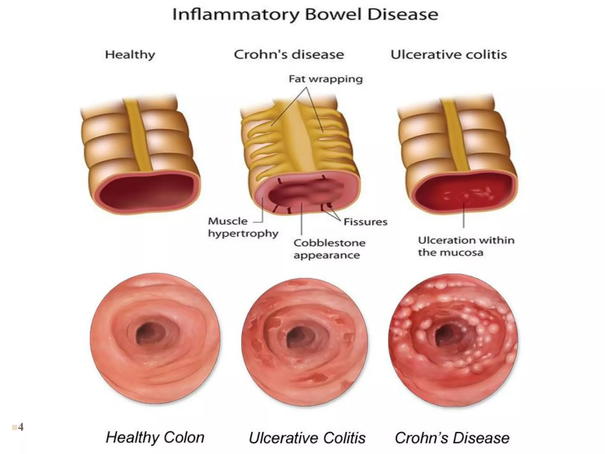 Inflammatory bowel disease | PDF