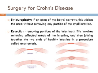 Inflammatory bowel disease | PDF