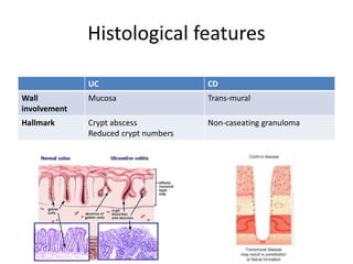Inflammatory bowel disease | PPTX