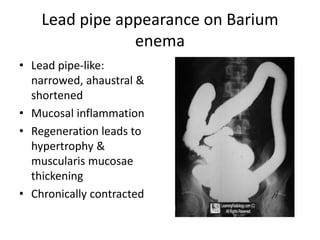 Inflammatory bowel disease | PPTX