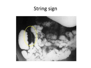 Inflammatory bowel disease | PPTX