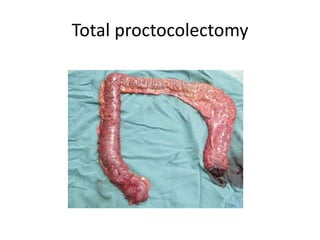 Inflammatory bowel disease | PPT