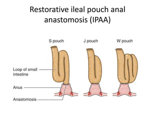 Inflammatory bowel disease | PPTX