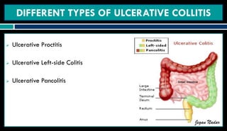Pathophysiology of Inflammatory bowel disease | PDF
