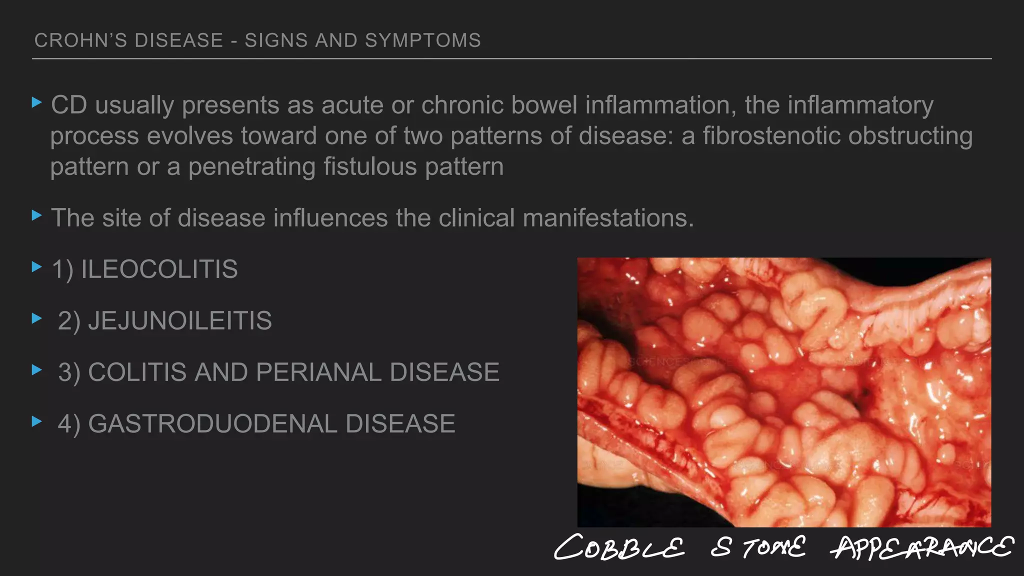 Inflammatory bowel disease - clinical features, diagnosis and ...
